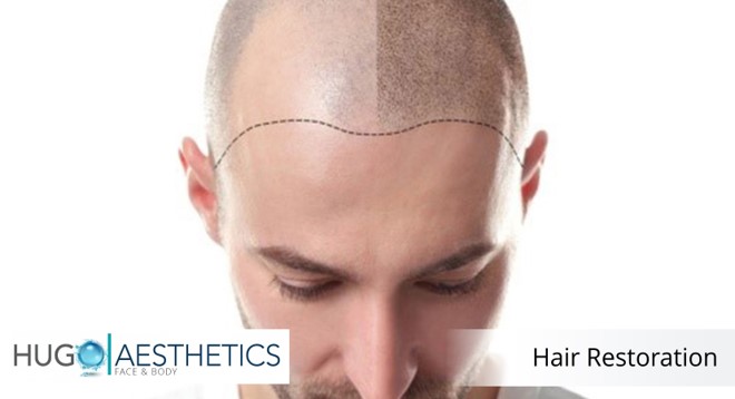 Hair Restoration Injections with Inno: Hugo Aesthetics